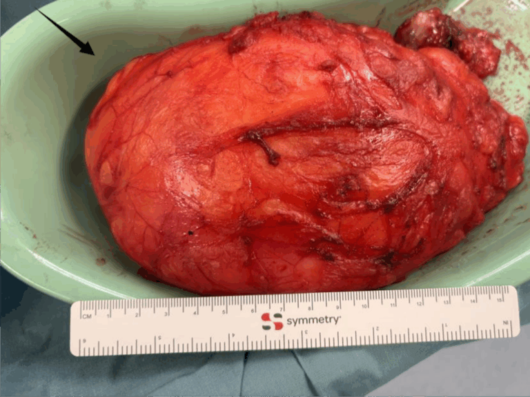 China Medical Team ‘s Breakthrough Breast Surgery Relieves Patient and ...